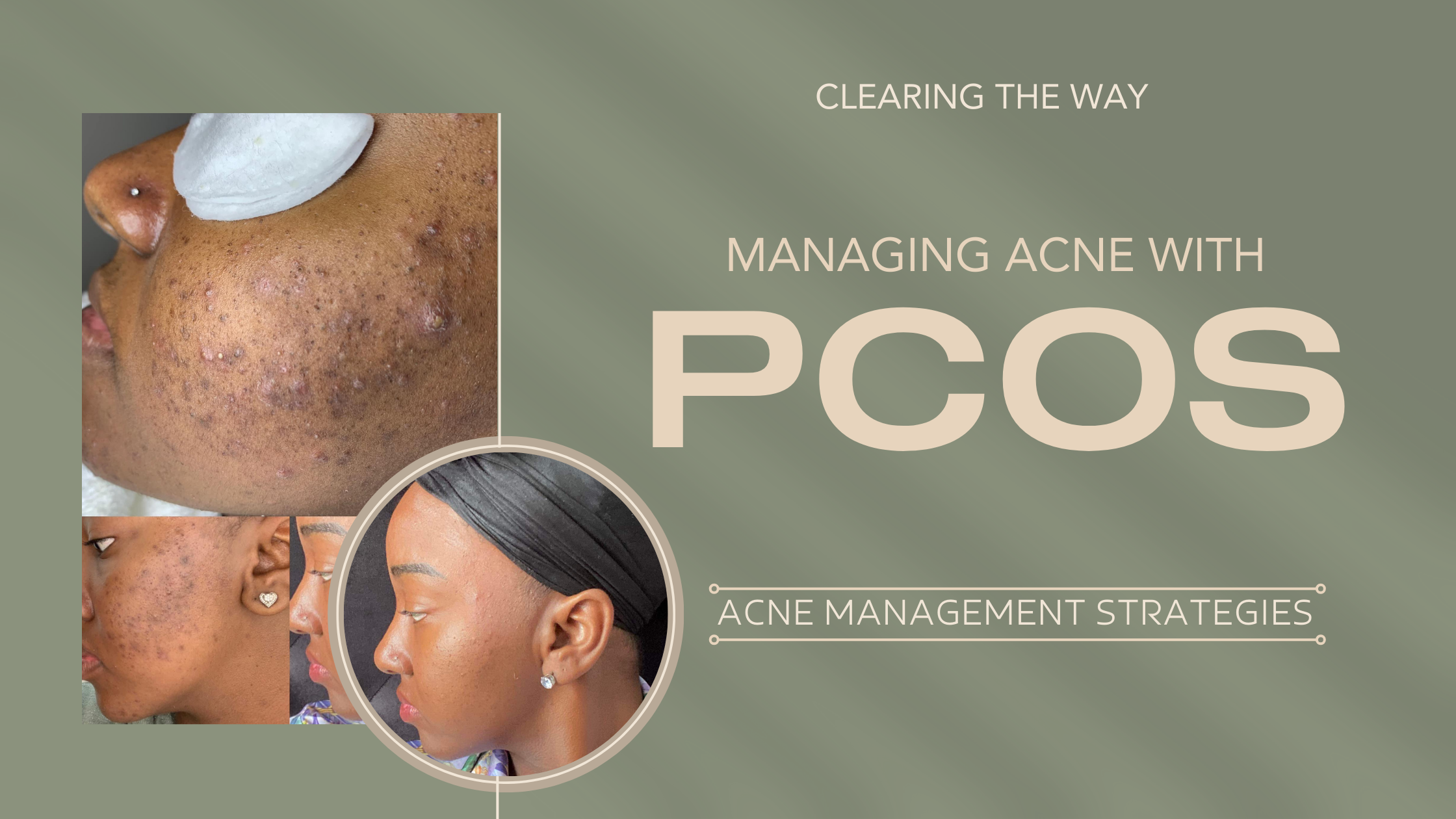 Managing Acne With PCOS – Skinostics